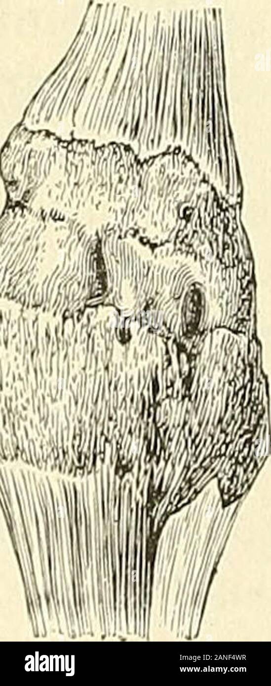 Formation of an abscess hi-res stock photography and images - Alamy