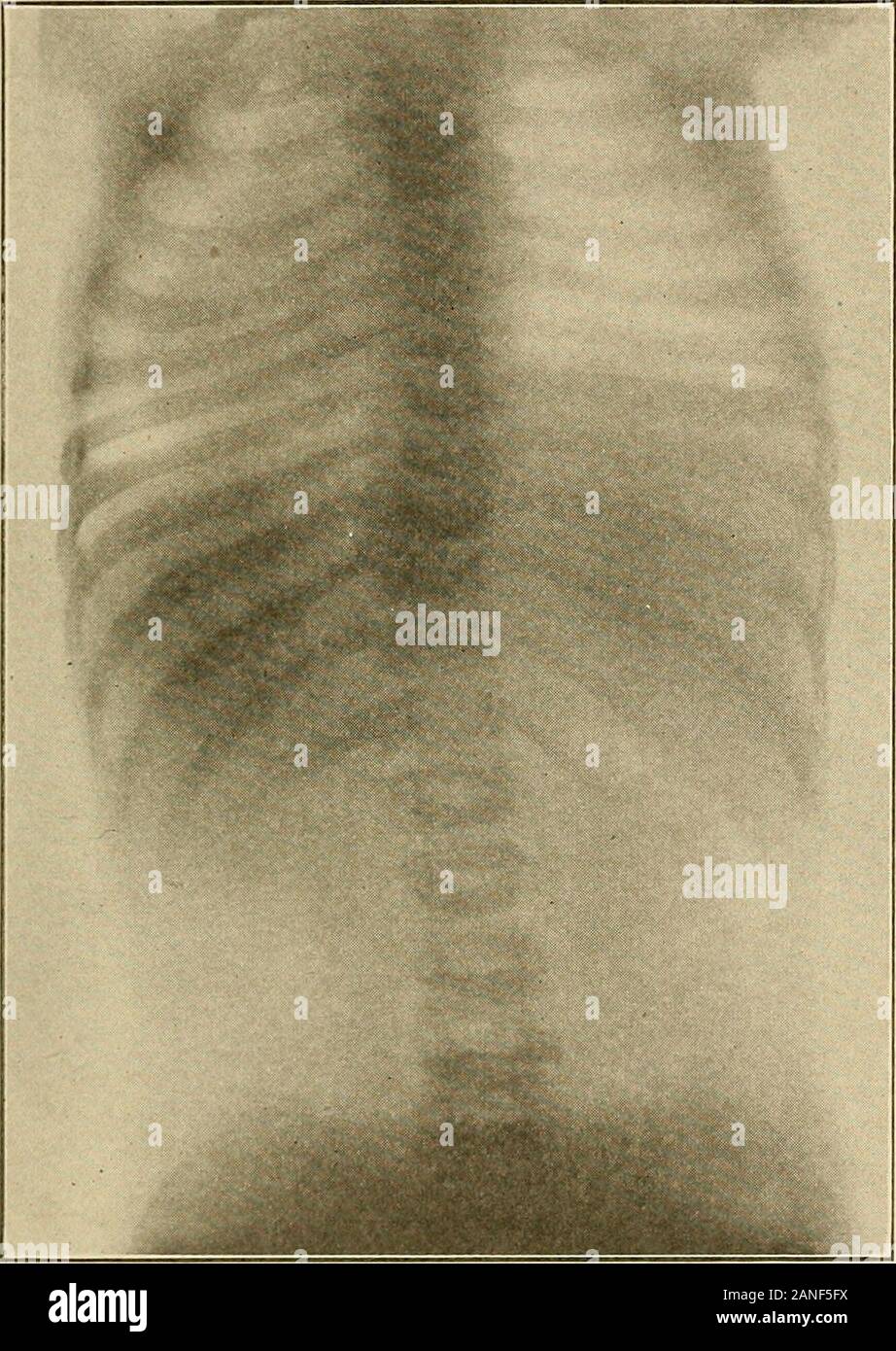 Lateral curvature of the spine and round shoulders . Fig. 151 ...