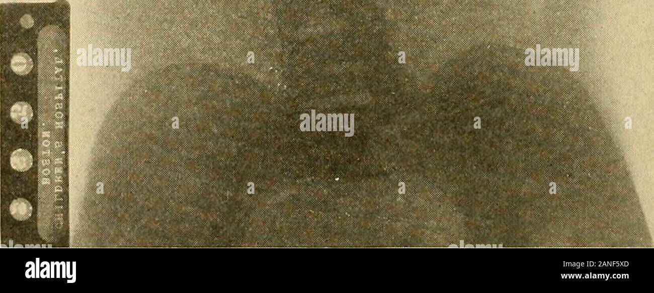Lateral curvature of the spine and round shoulders . Fig. 151 ...