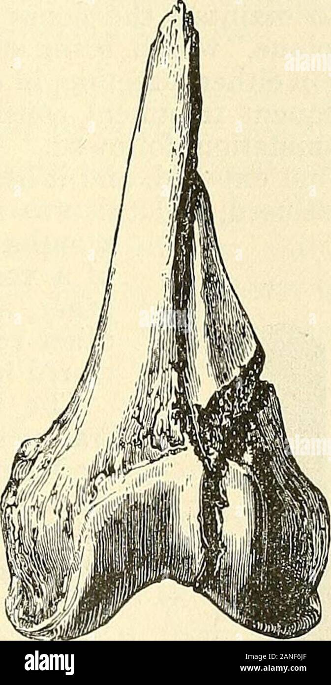 A practical treatise on fractures and dislocations . Dr. Crosbys ...