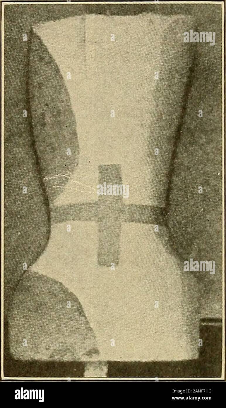 Lateral curvature of the spine hi-res stock photography and images - Alamy