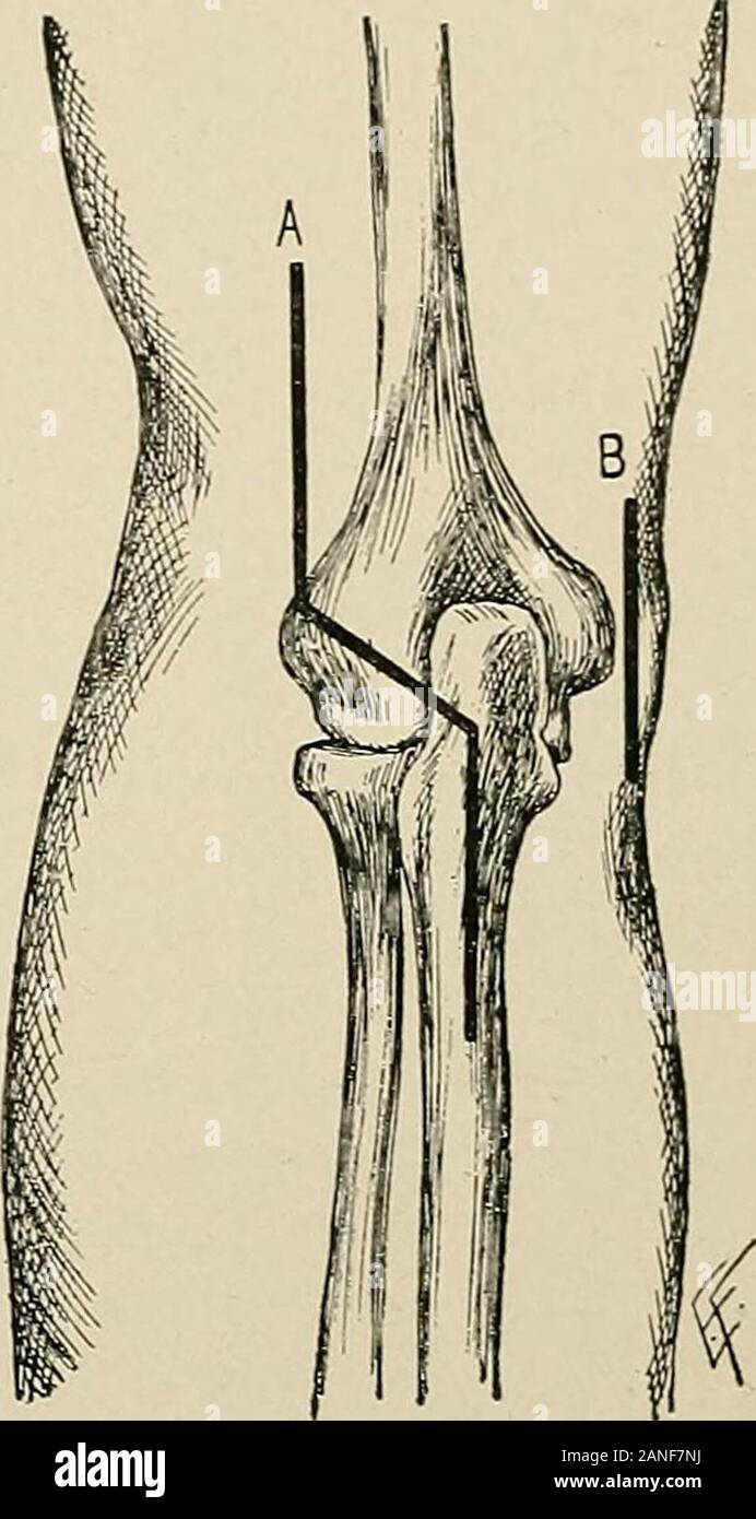 The practice of surgery . Fig. 655.—Excisions about elbow: A,Excision ...