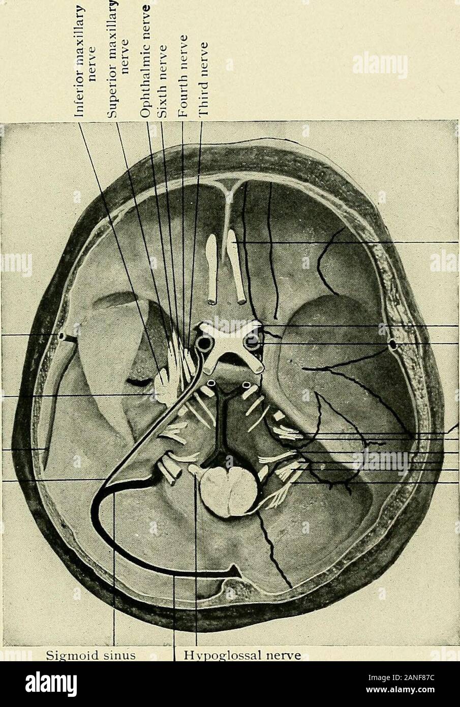 Osteoma hi-res stock photography and images - Alamy