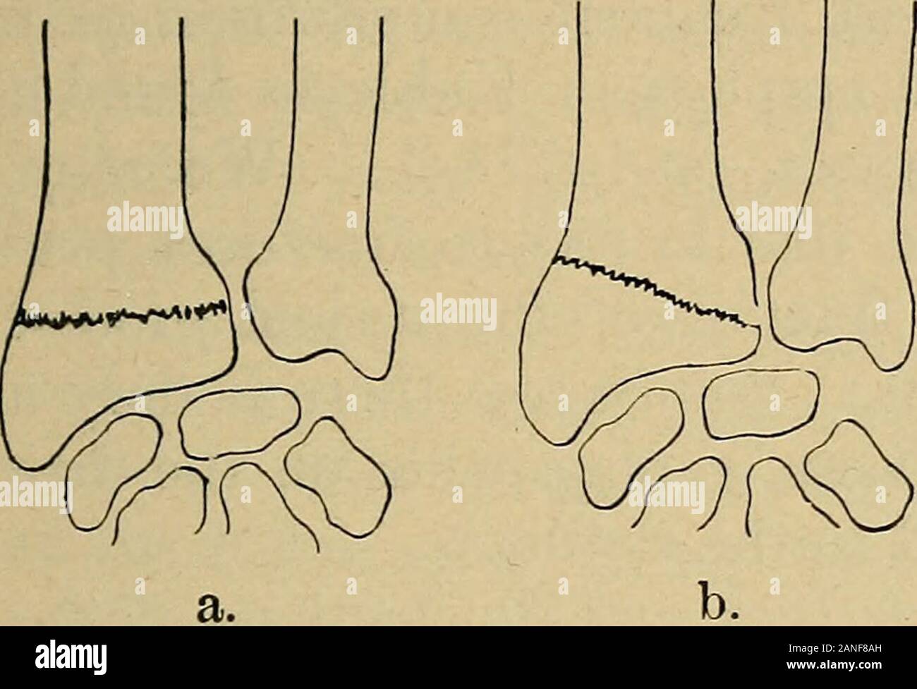 Atlas and epitome of traumatic fractures and dislocations . FRACTURES ...
