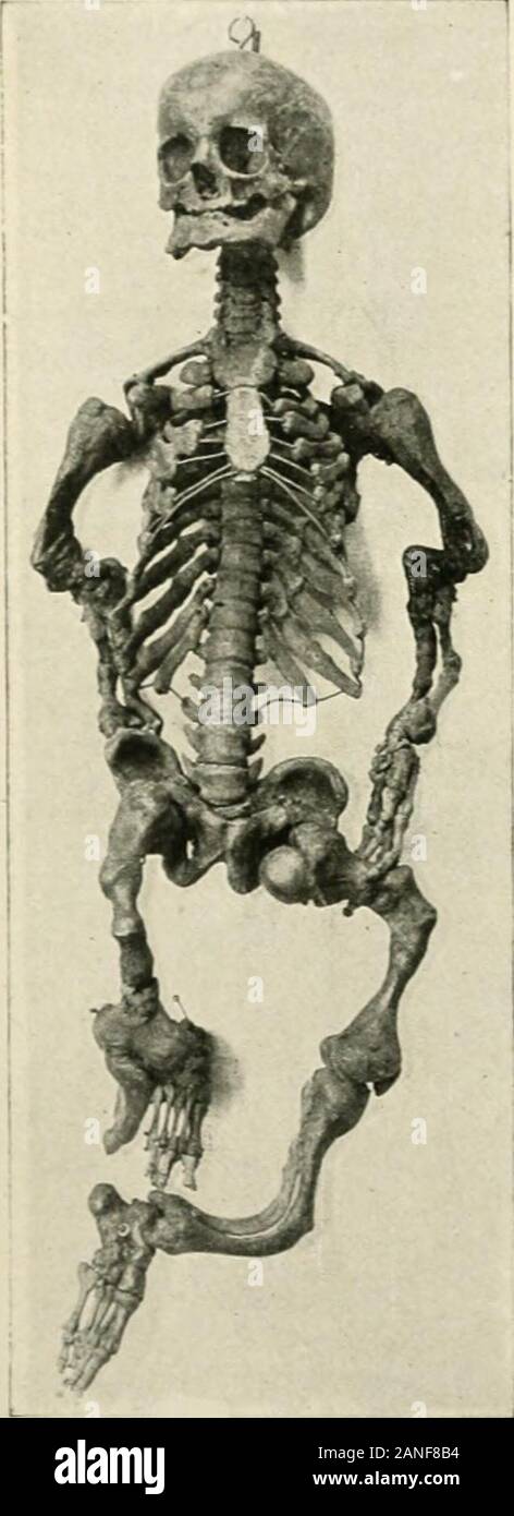 Softening of the bones hi-res stock photography and images - Alamy