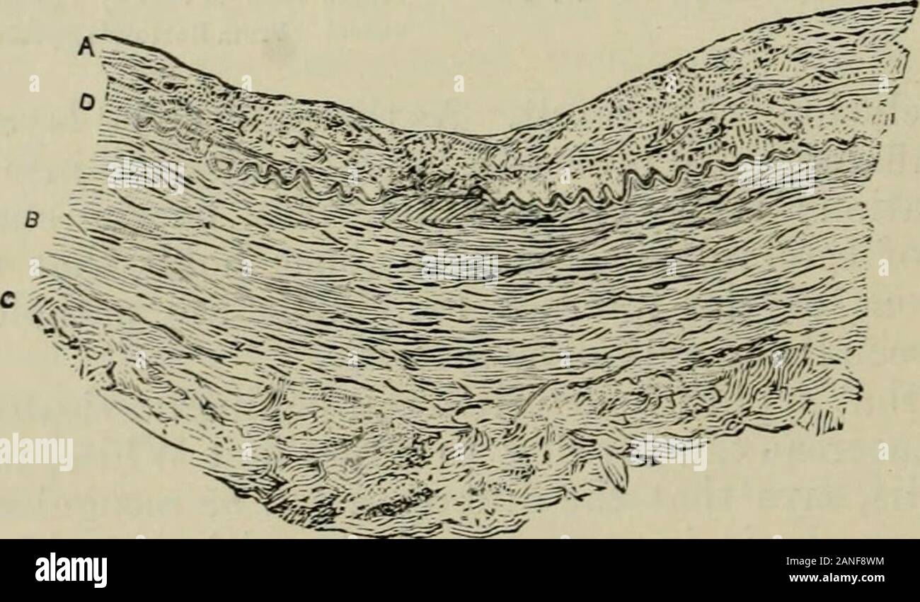 Atheroma formation hi-res stock photography and images - Alamy