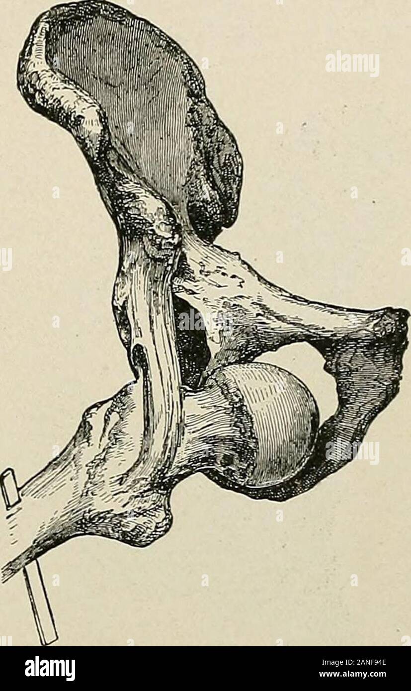 Anterior dislocation of the knee hi-res stock photography and images ...