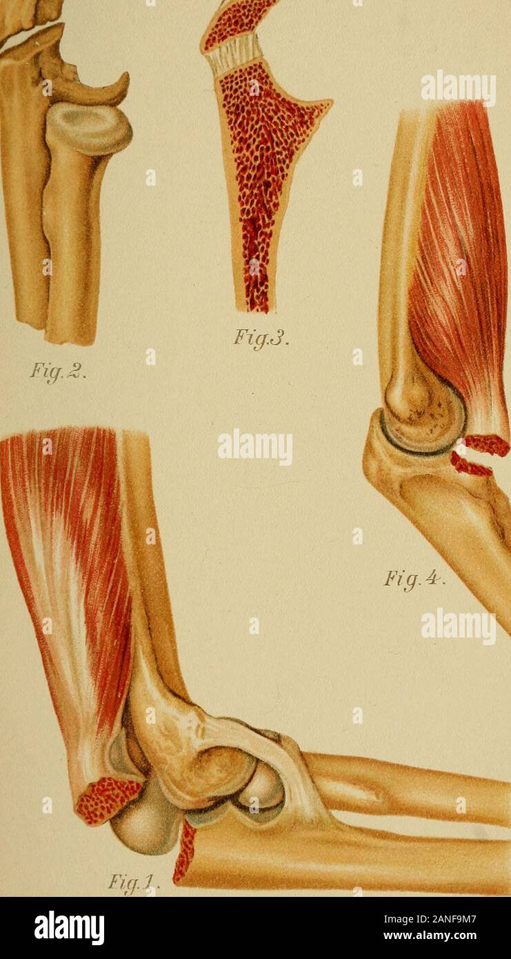 Atlas and epitome of traumatic fractures and dislocations . process ...