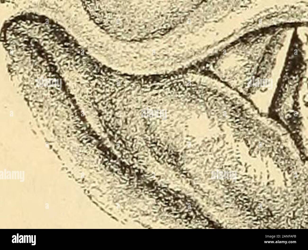 Cancer cachexia hi-res stock photography and images - Alamy