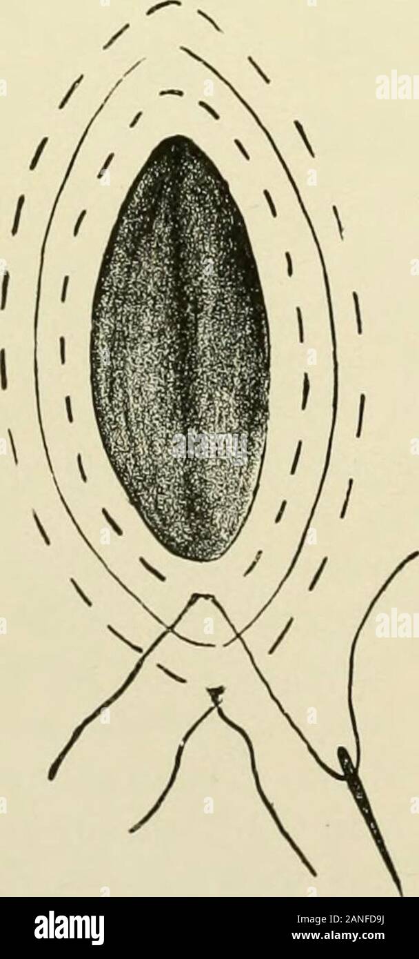 Operative surgery . Fig. 1411.—Cushings suture.. Fig. 1412.—Brenners ...