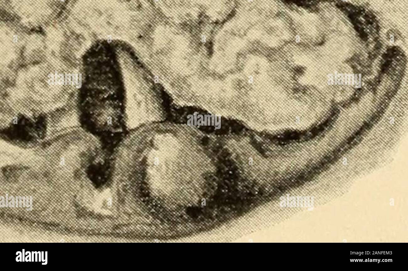 Syphilis ulcer hi-res stock photography and images - Alamy