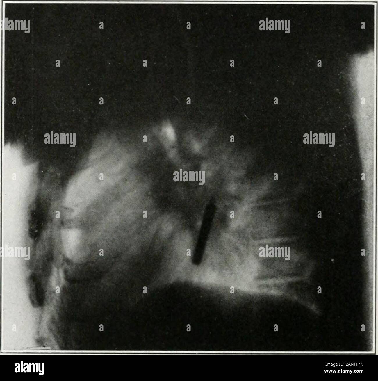 Peroral endoscopy and laryngeal surgery . Fir.. 399.—Radium capsule in ...