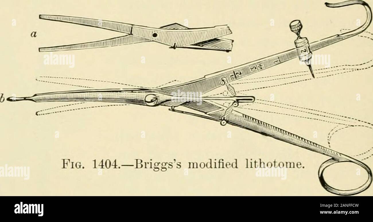 Operative surgery . Fig. 1403.—Woods staff andbisector. 1196 OPERATIVE ...