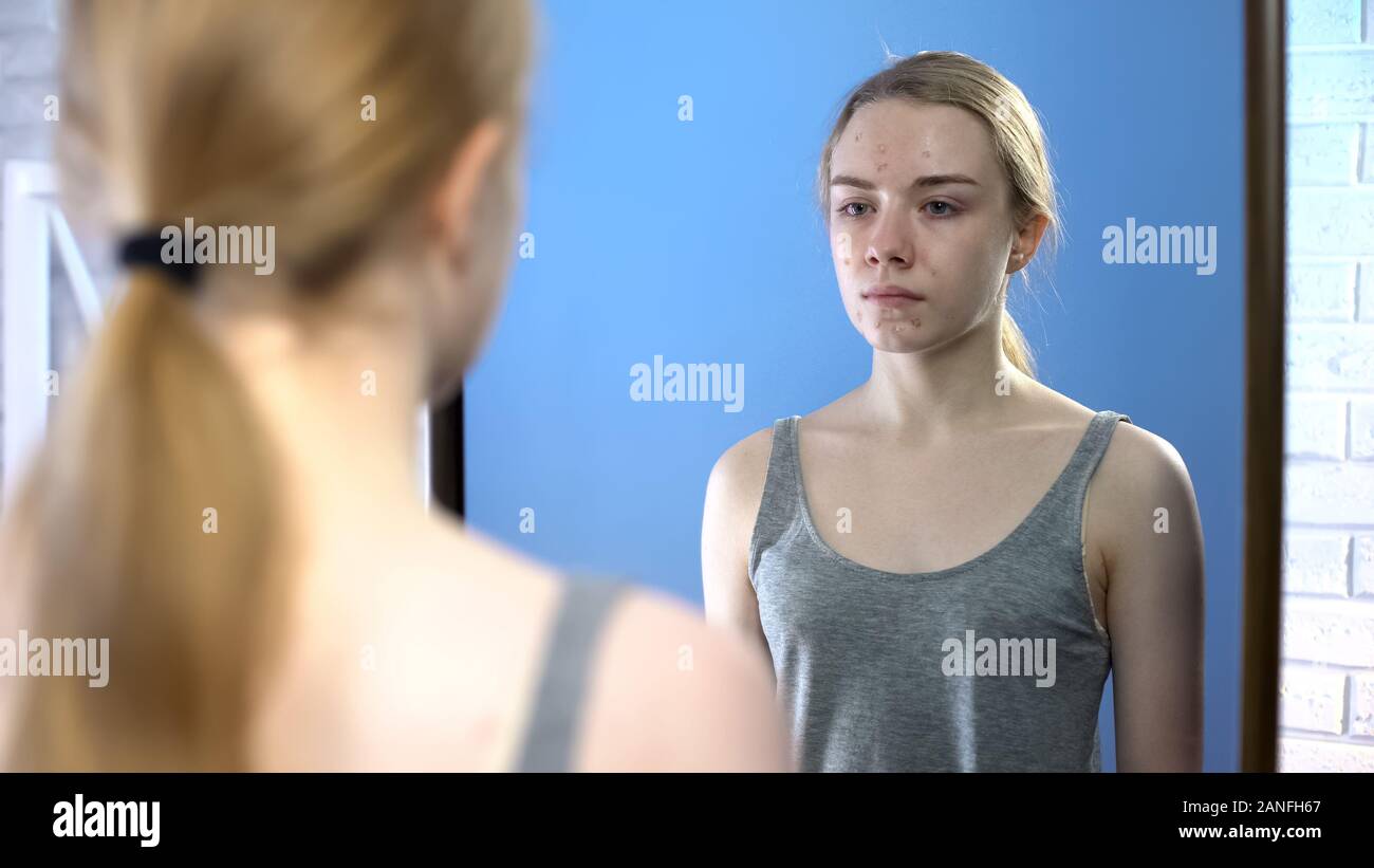 Girl with pimples on face looking in mirror feeling insecurities, skin ...