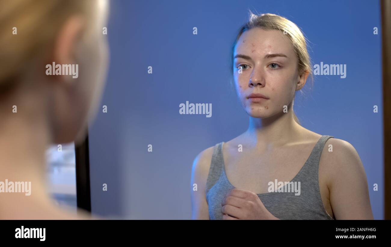 Girl with acne spots on face standing in front of mirror suffering ...