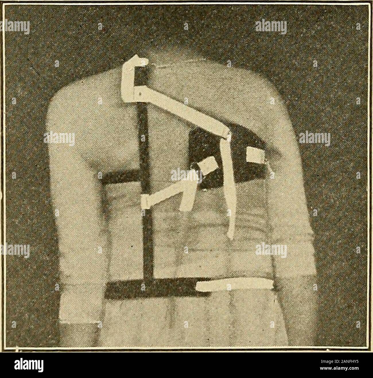 Lateral curvature of the spine and round shoulders . Fig. 121.—On the ...