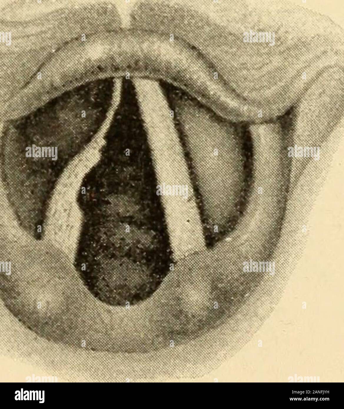 Gummatous lesions hi-res stock photography and images - Alamy