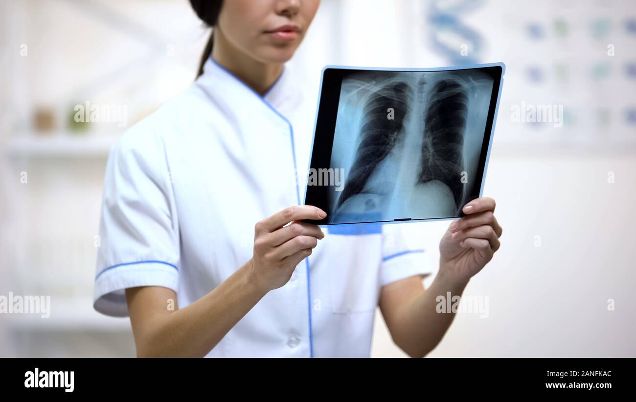 X ray bronchitis chest hi-res stock photography and images - Alamy