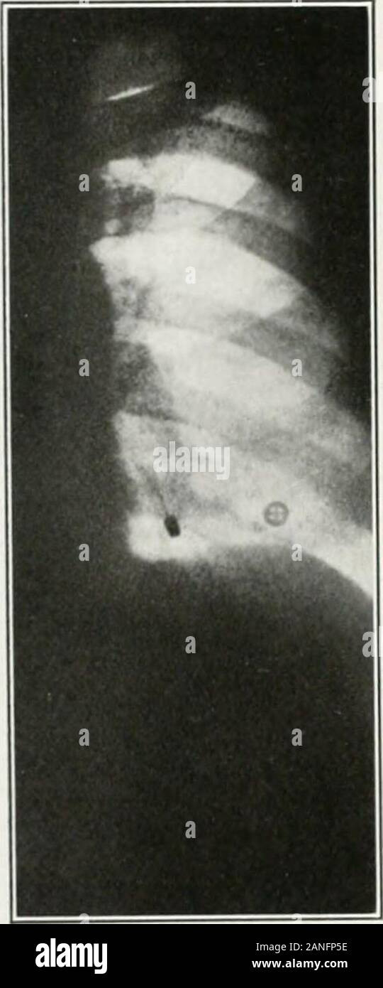 Endoscopy Esophagus High Resolution Stock Photography and Images - Alamy