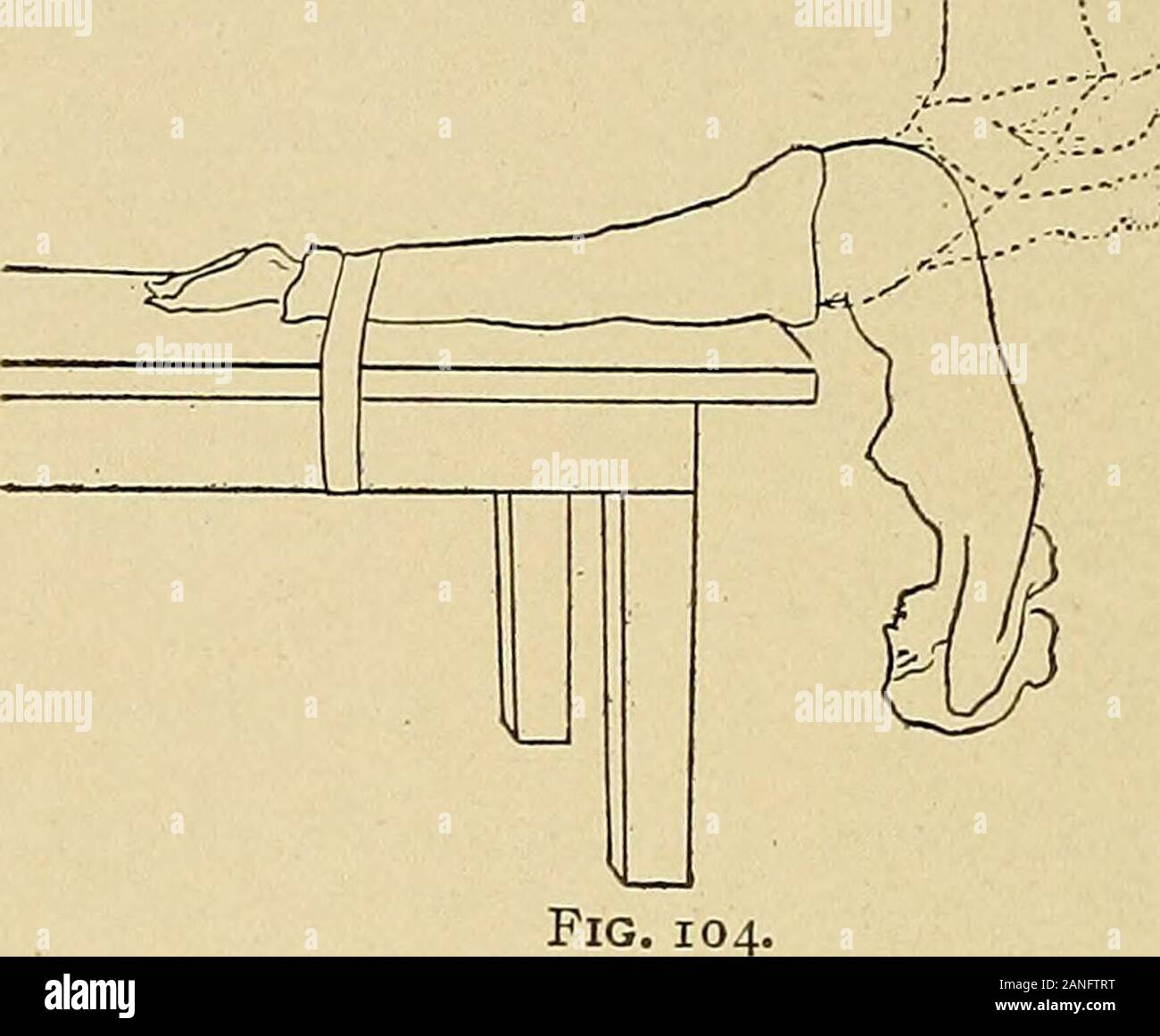 Lateral curvature of the spine and round shoulders . Fig. 103. hand ...