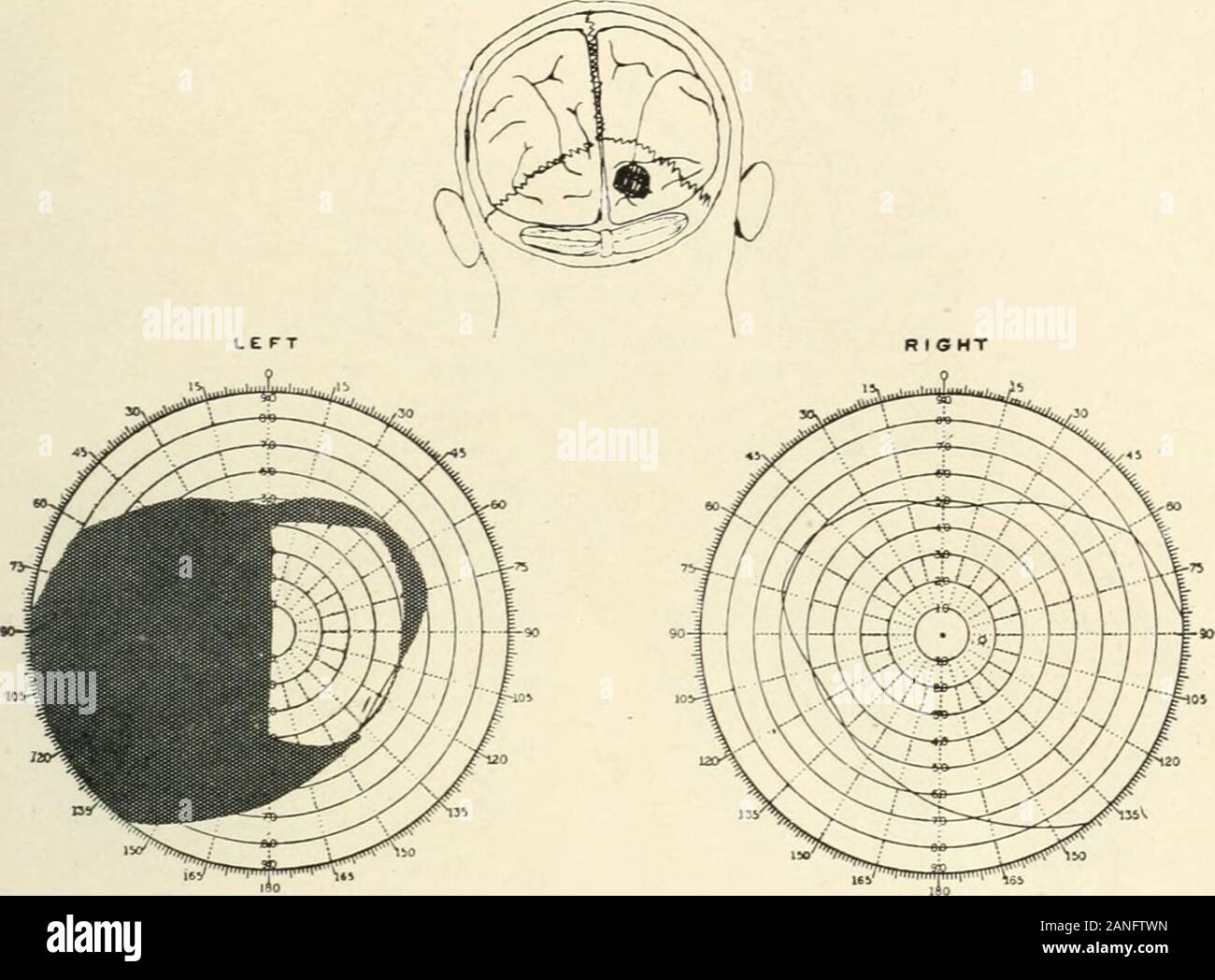 AMAarchives of neurology & psychiatry . Fig. 3 (Case 3. F. C. B ...