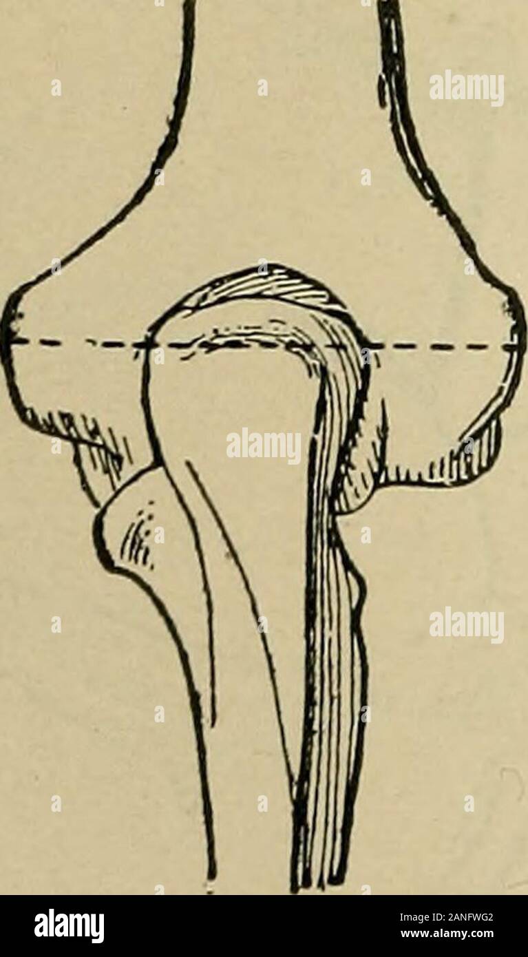Atlas and epitome of traumatic fractures and dislocations . Jbssa ...