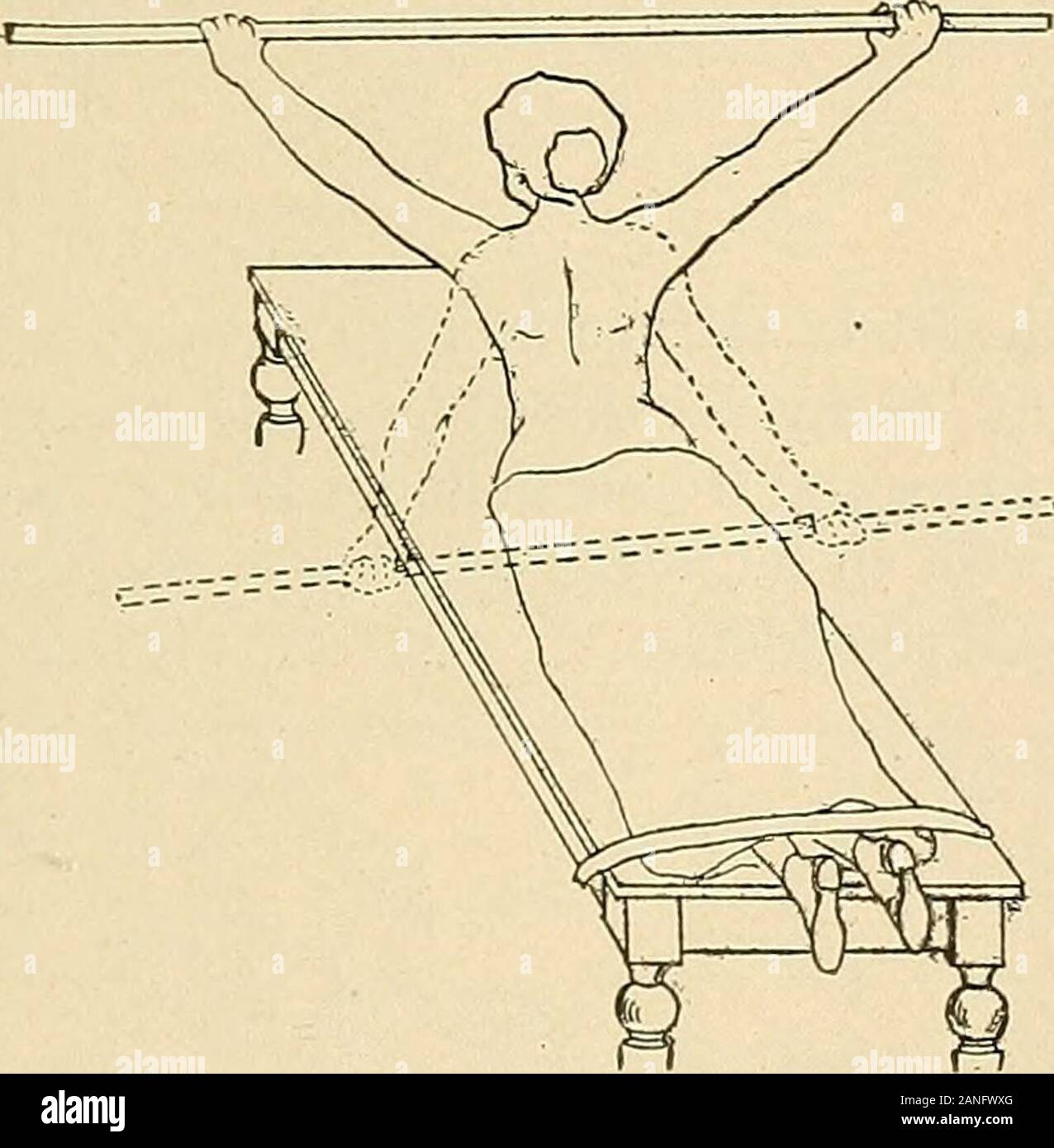 Lateral curvature of the spine and round shoulders . Fig. 100.. Fig ...