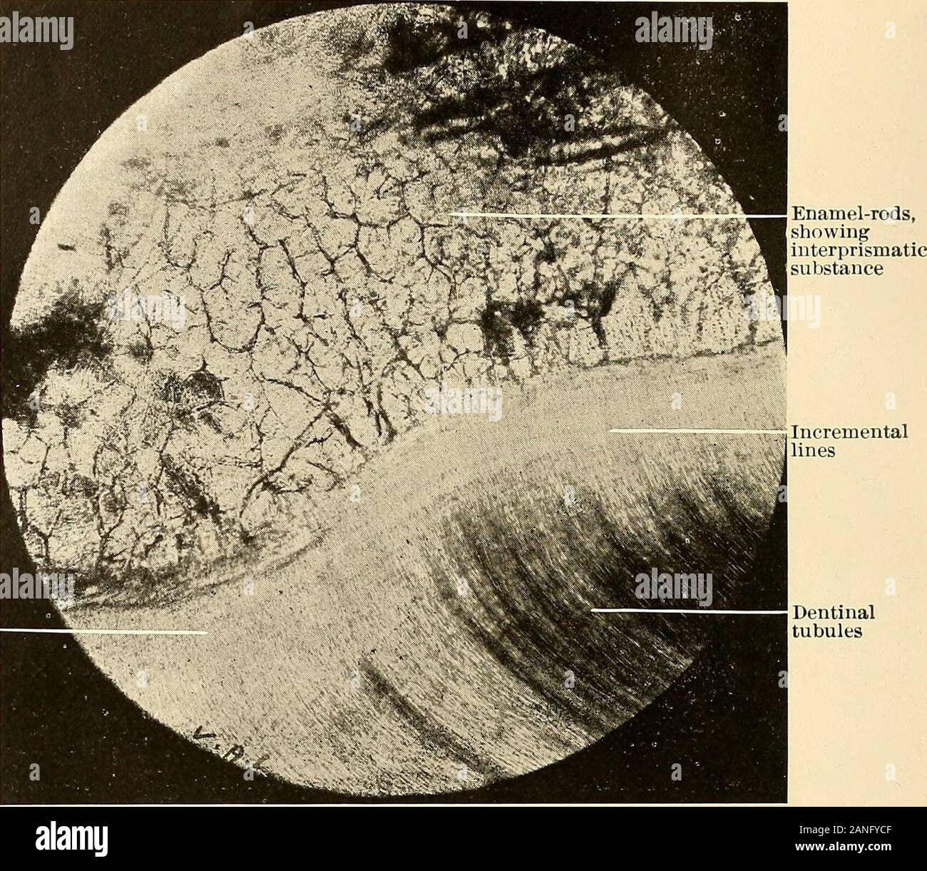 Interglobular Dentin