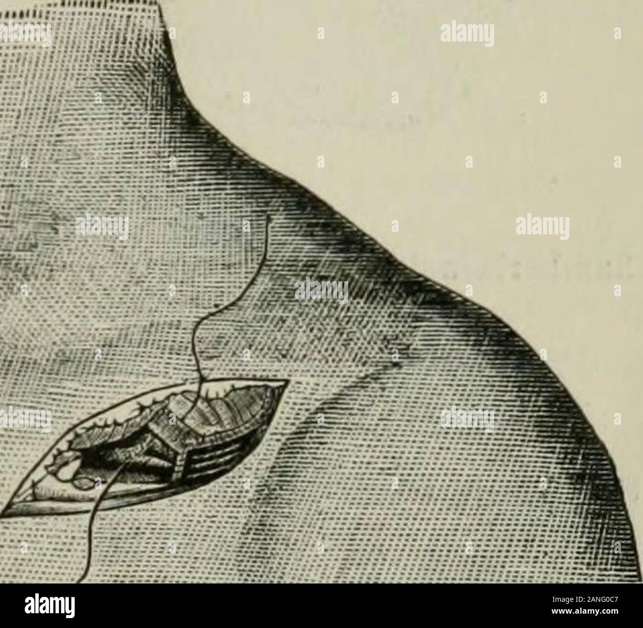 Sternal wound hi-res stock photography and images - Alamy