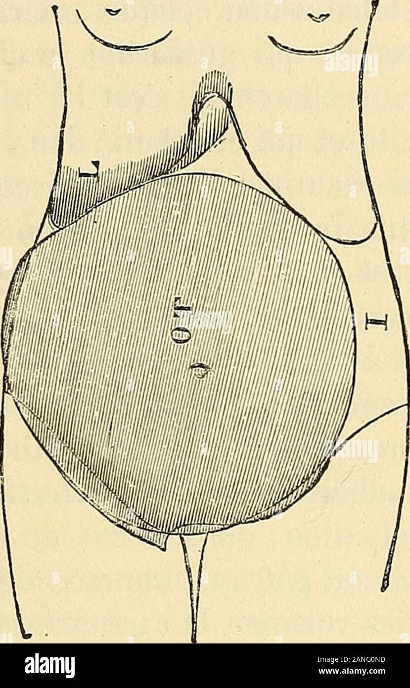 Traité de gynécologie clinique et opératoire . Fig. 336. — Topographie ...