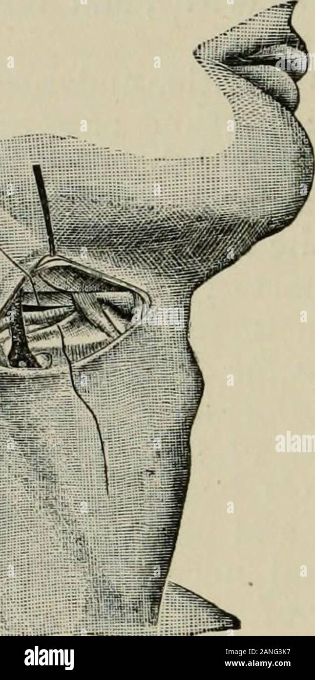 The international encyclopaedia of surgery; a systematic treatise on ...