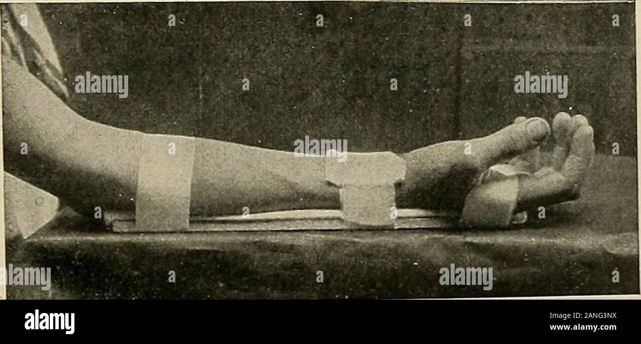 The practice of surgery . jTjo- 585.—Fracture o tne forearm near the ...