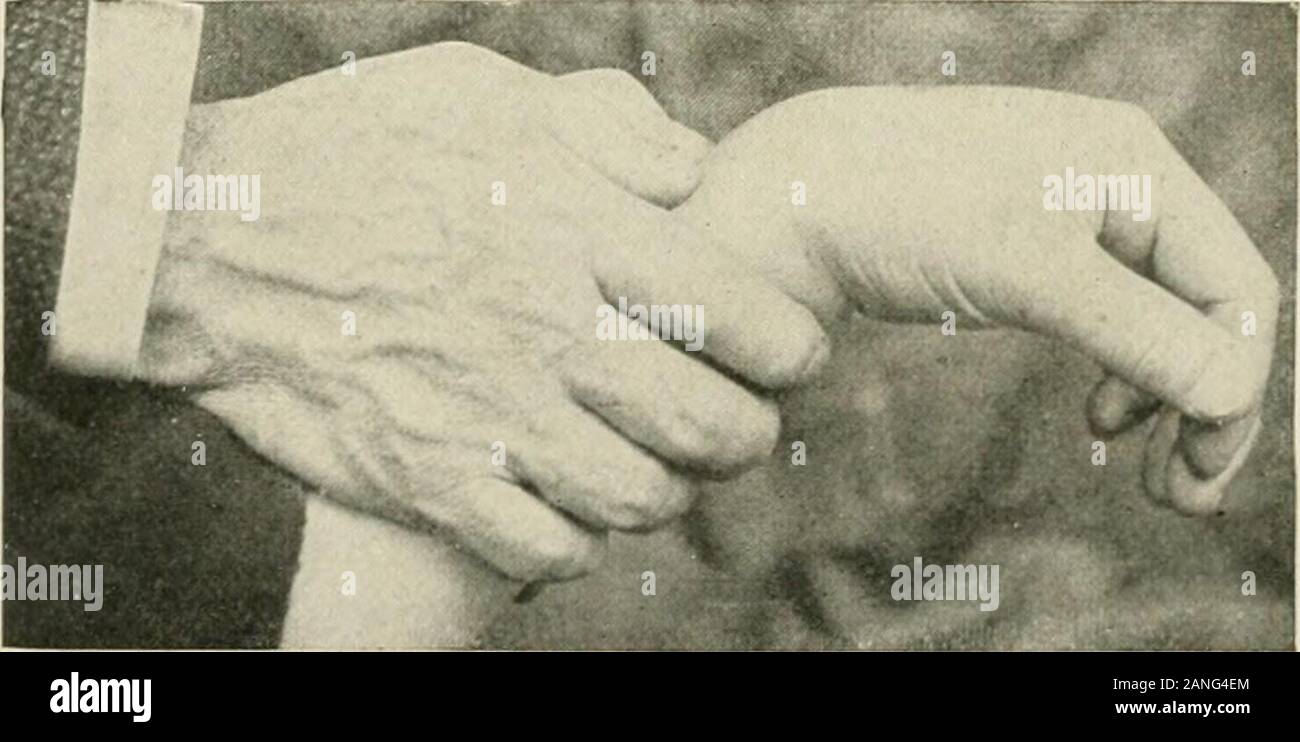 The practice of surgery . Fig. 583.—Reduction of Colles fracture. Nf>tf ...