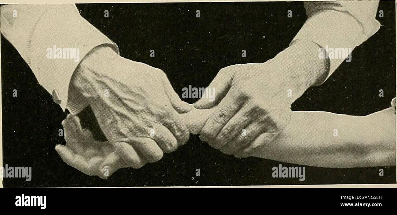 The practice of surgery . Fig. 581.—E. M. Moores dressing for Colles ...