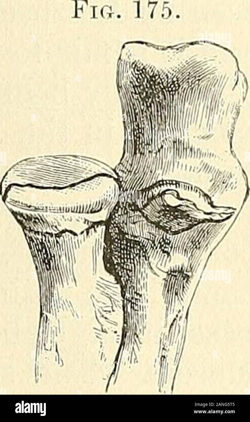 A practical treatise on fractures and dislocations . d cartilage. The ...