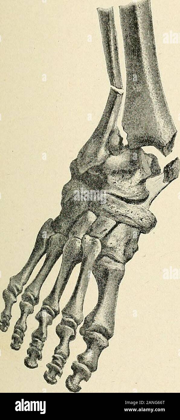 Ankle roll hi-res stock photography and images - Alamy