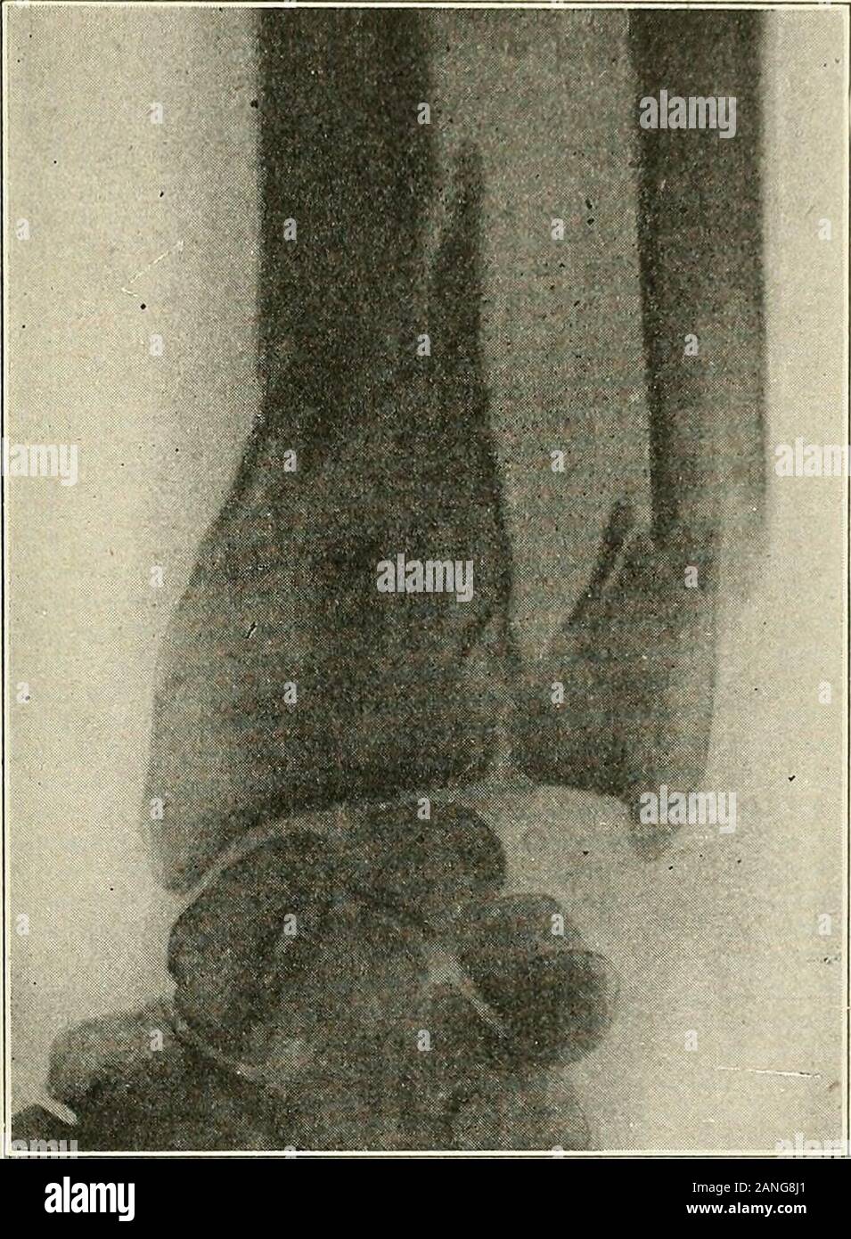 A text-book of first aid and emergency treatment . Fig. 86.—Fracture of ...