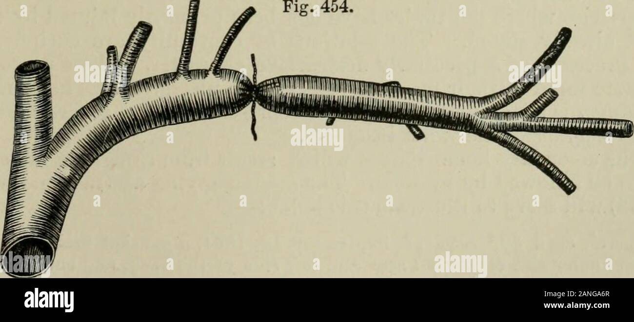 The international encyclopaedia of surgery; a systematic treatise on ...