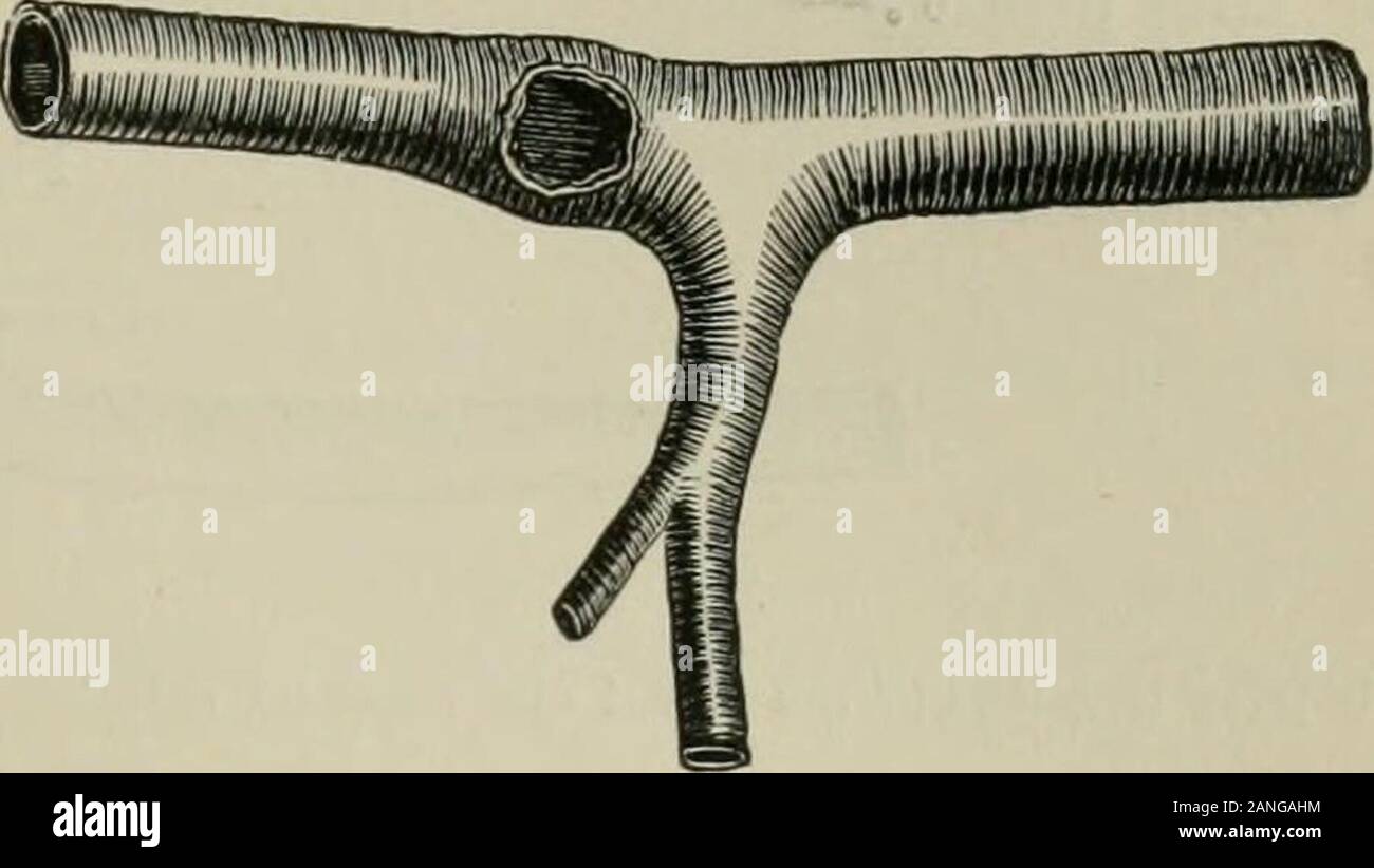 The international encyclopaedia of surgery; a systematic treatise on ...