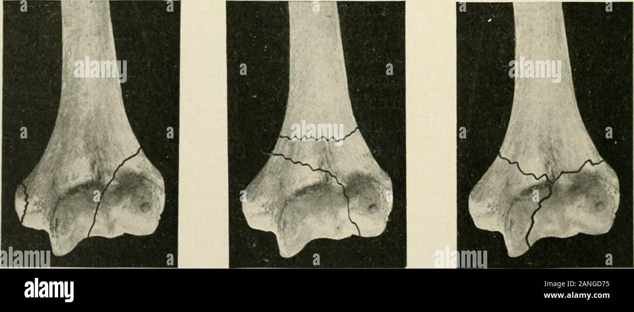 Epicondyle Vs Condyle