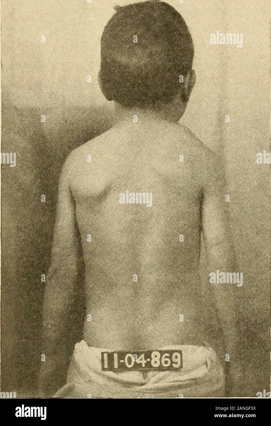 Lateral curvature of the spine and round shoulders . of congenital ...