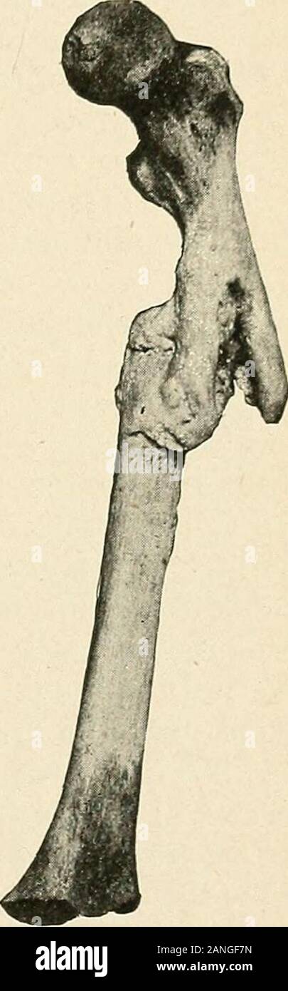 Callus after radius bone fracture hi-res stock photography and images ...