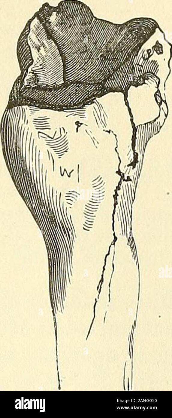 A practical treatise on fractures and dislocations . Impacted fracture ...