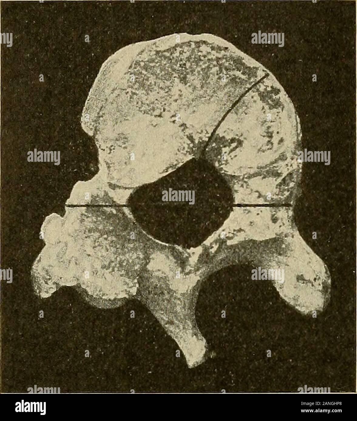 Lateral curvature of the spine and round shoulders . le between the ...
