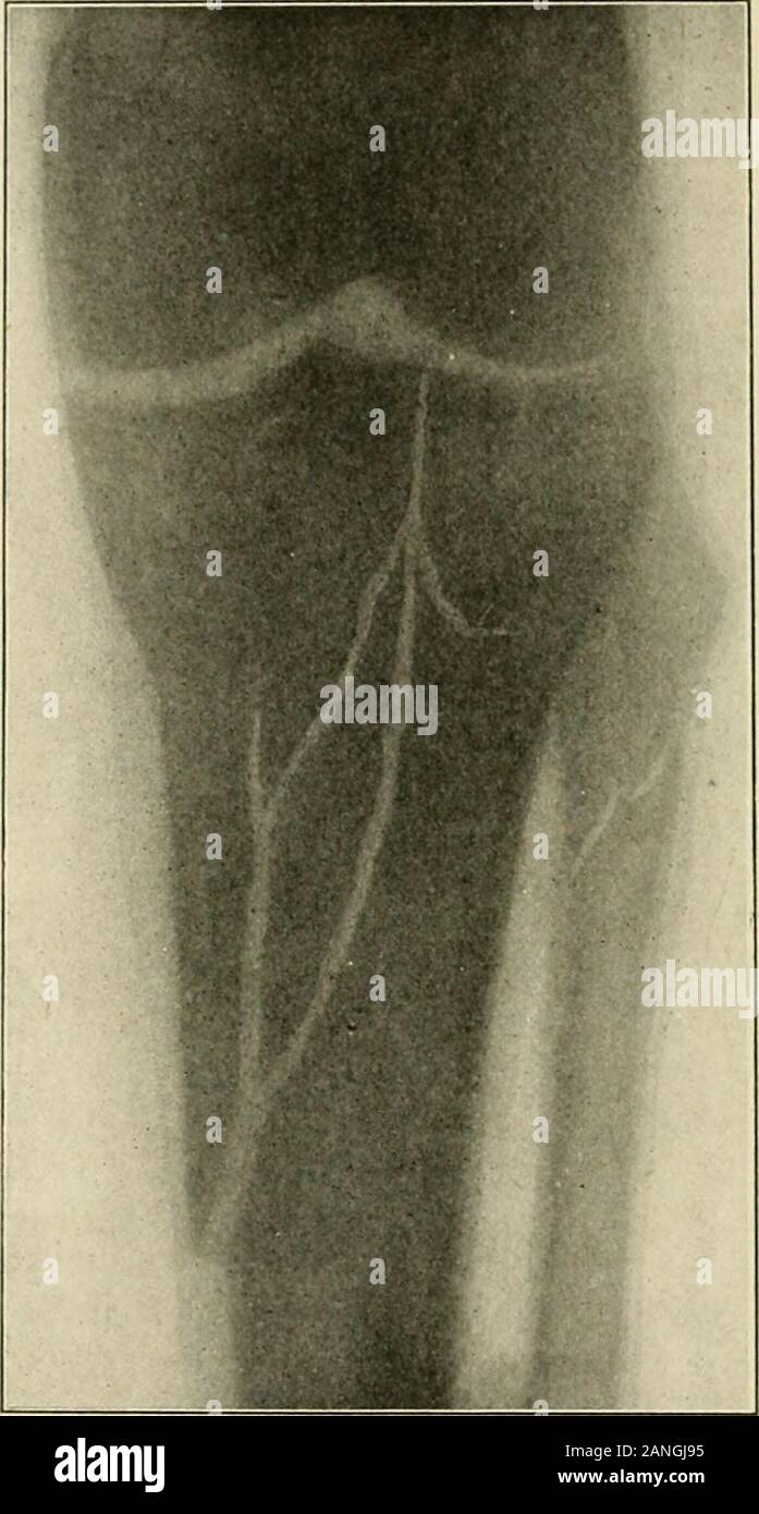 Oblique bone fracture hi-res stock photography and images - Alamy