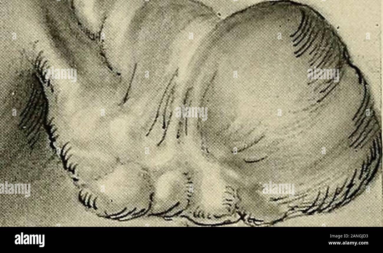 Gynecology . v ^ -*. Fig. 365.—Salpingectomy.The tube of the left side ...
