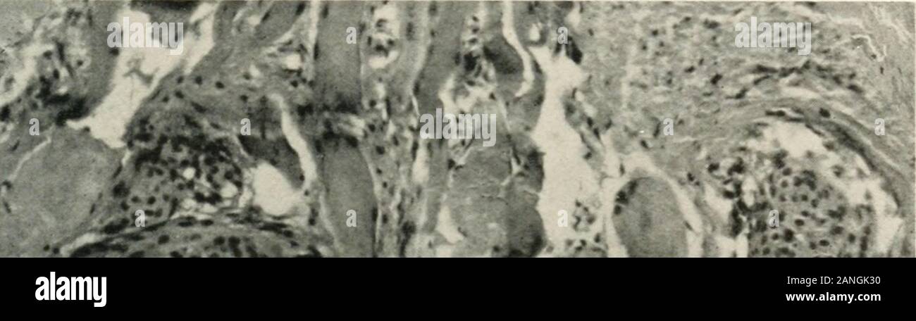 Bone spicules hi-res stock photography and images - Alamy