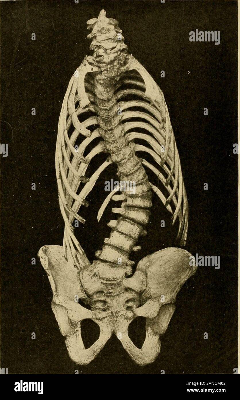 Lateral curvature of the spine and round shoulders . erer cases angular ...