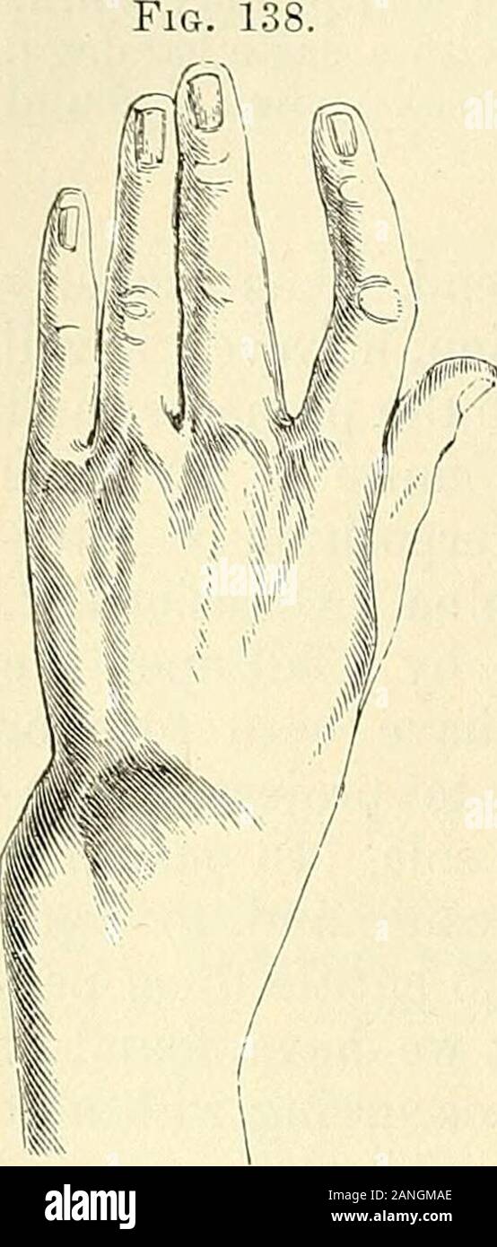 Colles bone fracture hi-res stock photography and images - Alamy