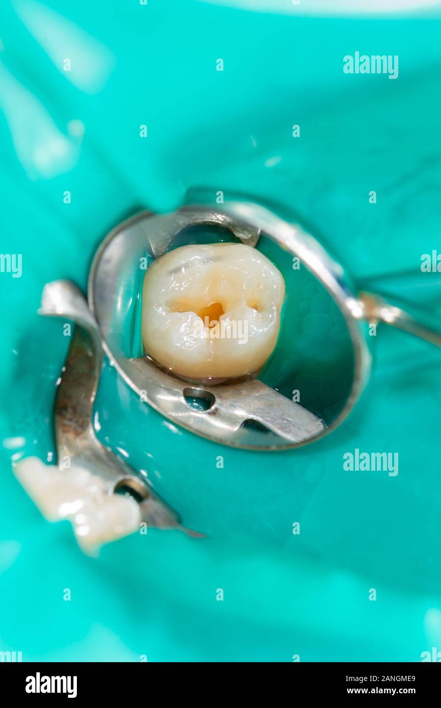 two chewing side teeth of the upper jaw after treatment of caries ...